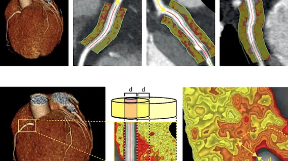 Novel cardiac imaging biomarker could predict risk of coronary ...