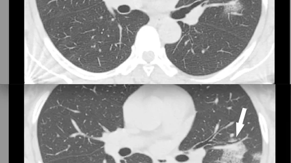 How effective are chest CT severity scores in managing COVID?