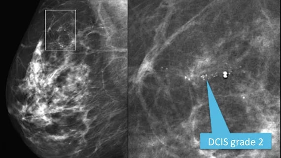 Why the way microcalcifications on mammograms are regarded could change