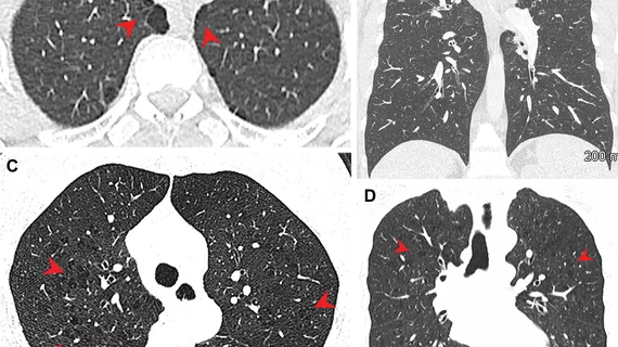 Why do chest CT findings differ between marijuana and tobacco-only smokers?