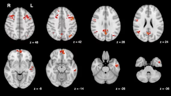 How patients' focus affects data derived from functional MRI scans