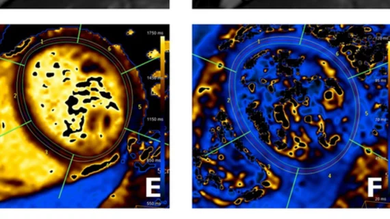 Experts develop cardiac MRI reference values for healthy adolescents