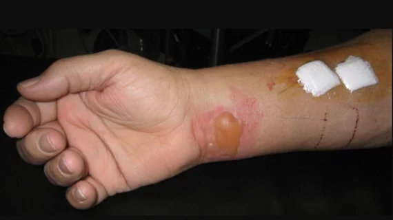 Battling Burns in MRI