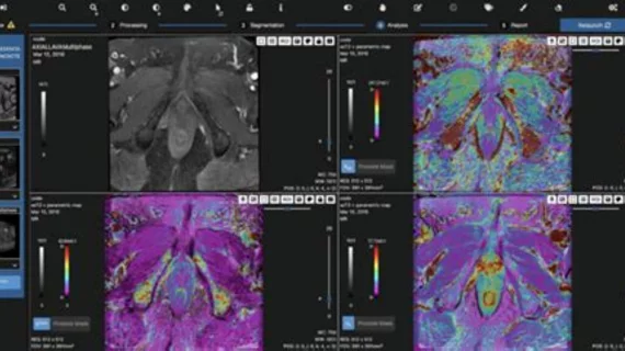 Philips, Quibim integrate for AI-powered prostate cancer diagnosis