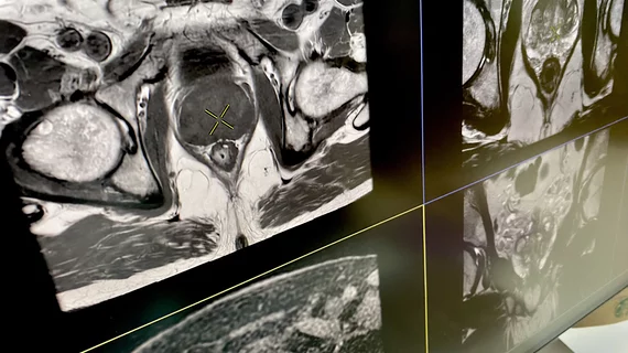 Factors that increase the likelihood of false results on prostate MRI