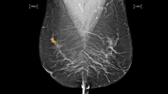 AI loaded onto mammography systems can flag possible cancers in real ...