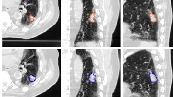 Deep learning model halves lung tumor segmentation times