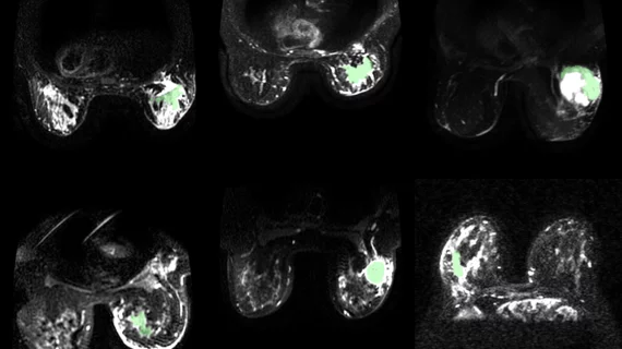 MRI technique makes breast cancer 'glow' on imaging