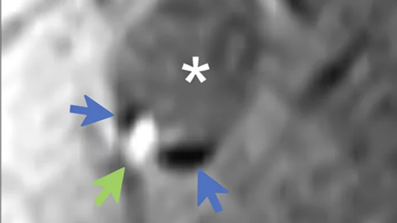 Calcified carotid plaques more likely to rupture than previously ...