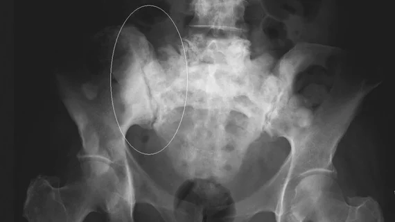 1st patient dosed with new radiopharmaceutical targeting cancer bone pain