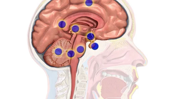 AI helps radiologists detect brain aneurysms