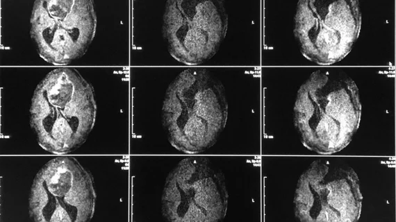 How one institution successfully introduced BT-RADS to radiologists