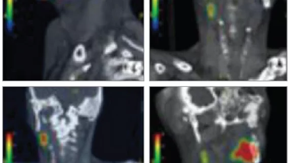 Experts release new appropriate use criteria for lymphoscintigraphy in ...