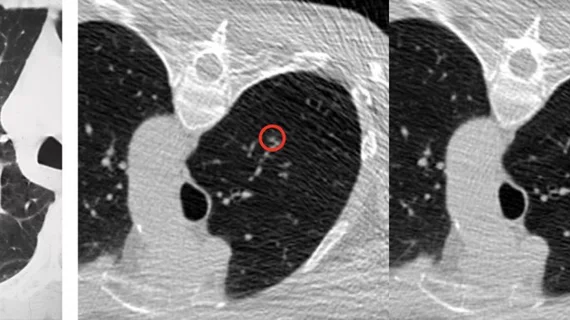 Reducing image-guided lung biopsy complications