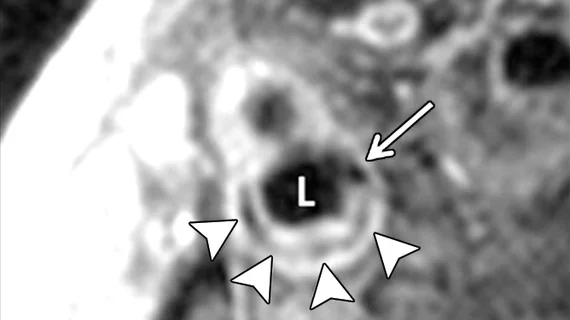 How the shape, size and location of calcified carotid plaques affect ...