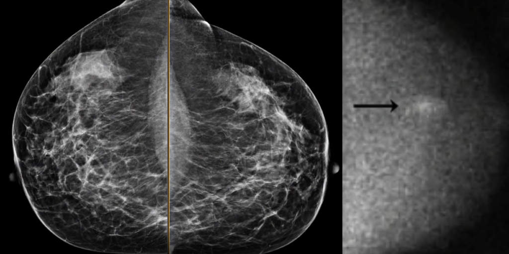 mammogram screening abnormality